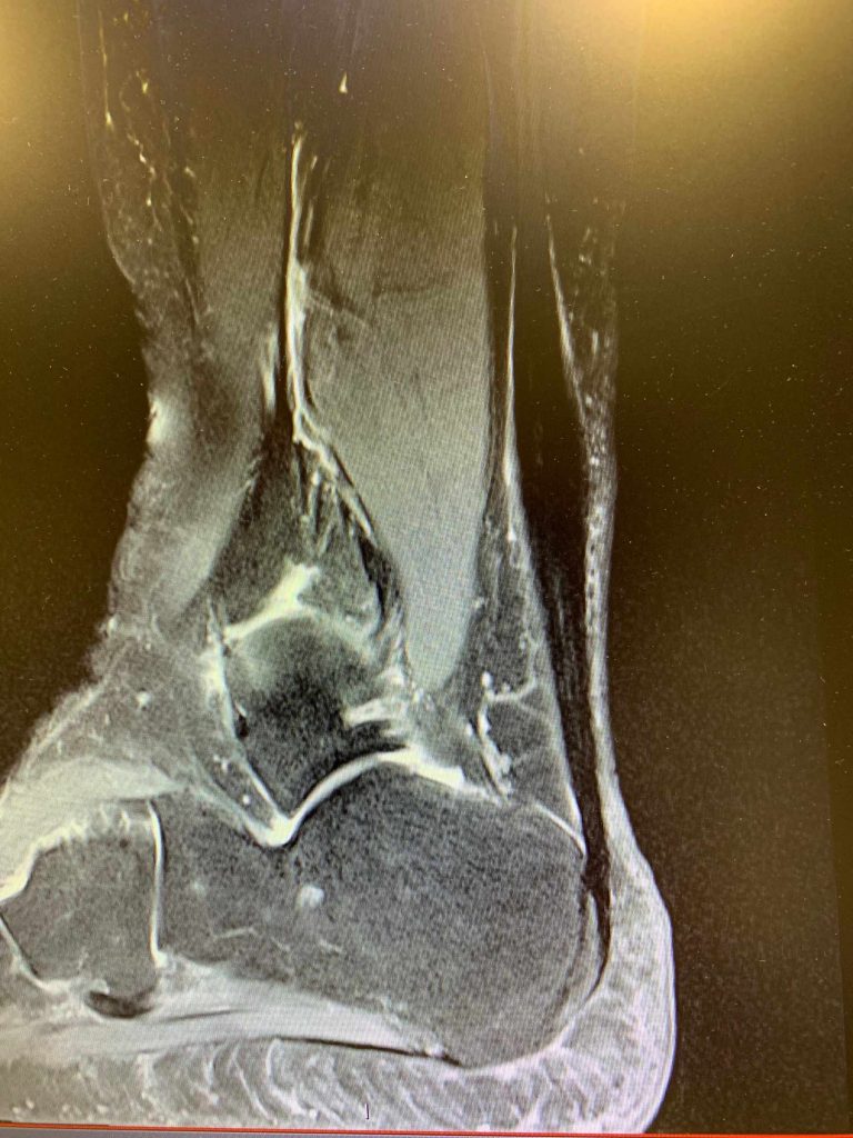 Taustaa akilles-vammoihin - Urheiluortopedi Lasse Lempainen