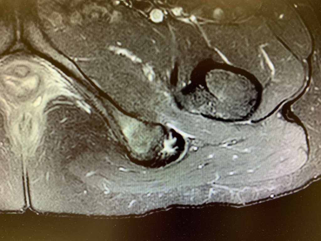 Hamstring syndrome / proximal hamstring tendinopathy information ...
