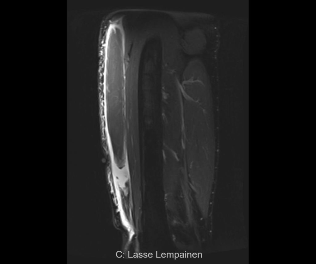 Rectus femoris injury information - Urheiluortopedi Lasse Lempainen