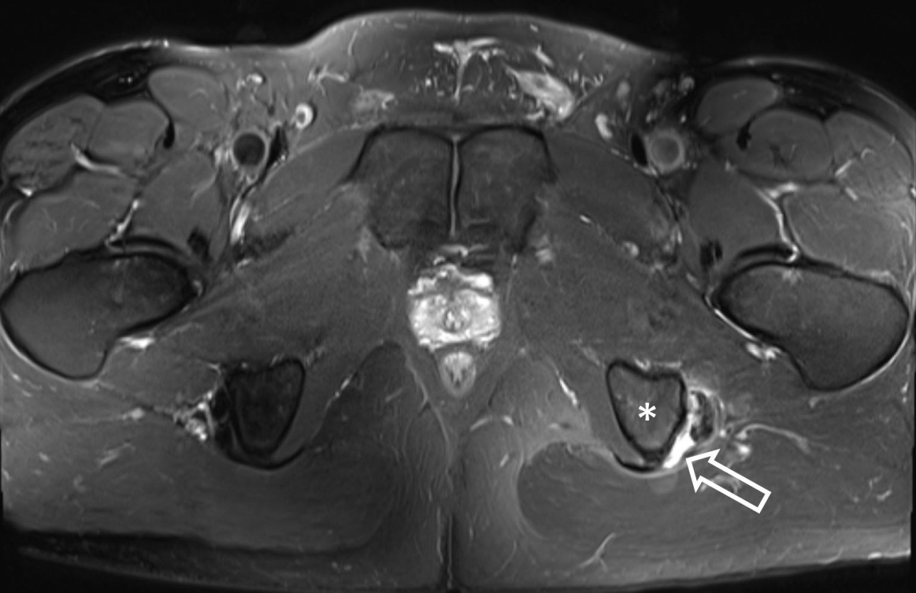 Hamstring injury information - Urheiluortopedi Lasse Lempainen