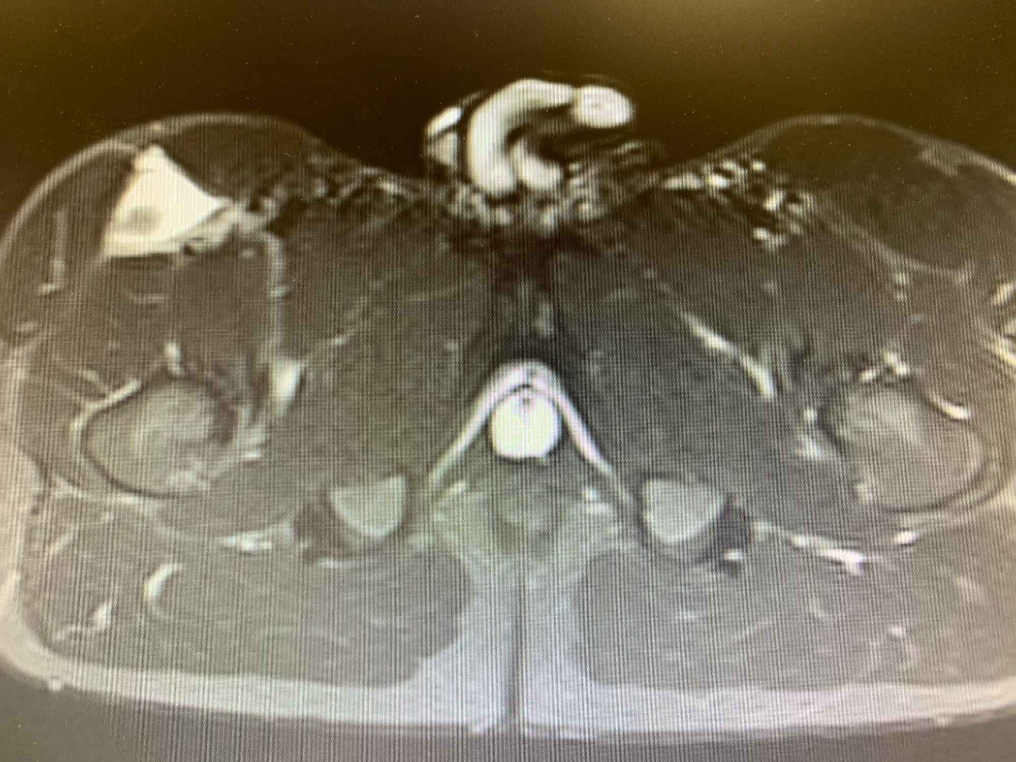 Rectus femoris injury information - Urheiluortopedi Lasse Lempainen